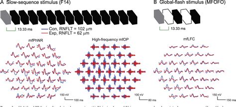 Figure 2 From Relation Between Macular Retinal Ganglion Cellinner