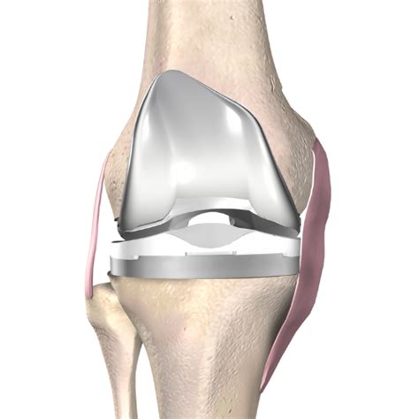 Mako For Total Knee Replacement Alabama Bone And Joint Clinic