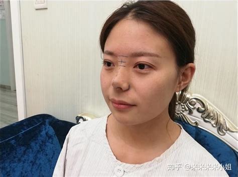 武汉隆鼻医院医生哪里好，术后案例分享 知乎