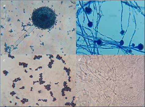 A And B Lpcb Mount Shows Aspergillus Spp Under Microscopic Examination