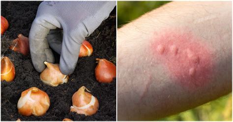 Rashes From Plants Images