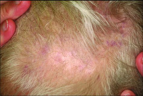 Cancerous Scalp Lesions