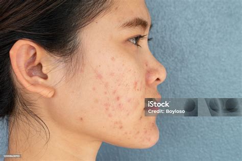 그녀의 뺨에 여드름 염증 의 문제가있는 여성의 반 얼굴의 측면보기 여드름에 대한 스톡 사진 및 기타 이미지 여드름 뾰루지