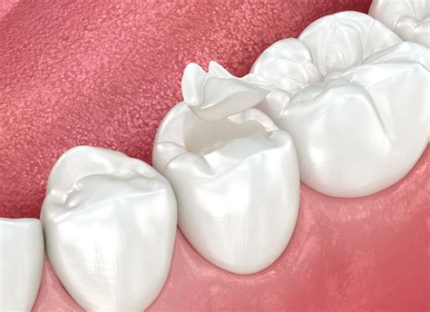 Long Term Clinical Performance Of Posterior Resin Composite