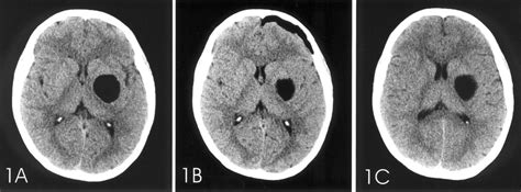 Figure 1 Sequential Ct Scans For Case 1 A Pre Operative Basal
