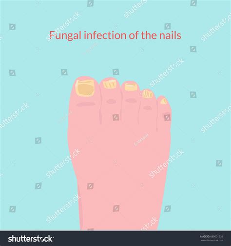 Fungal Infection Nails Vector Medical Illustration Stock Vector