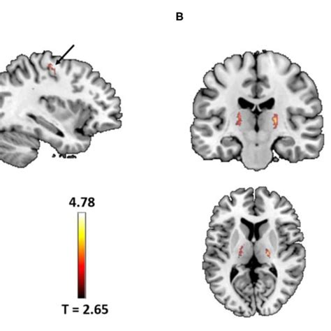 A Significant Increased Quantitative Susceptibility Mapping Qsm Download Scientific