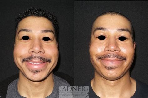 Facial Plastic Surgery For Men Before And After Photo Gallery Denver