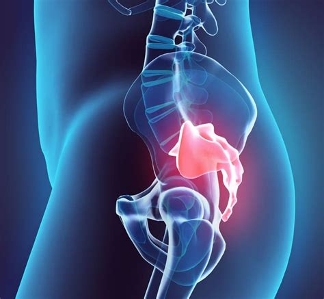 Stress Fracture In Sacrum Symptoms At Carl Osborne Blog