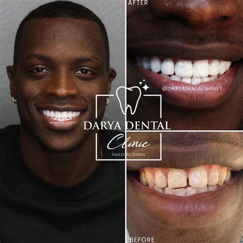 Gum Contouring Daryadentalclinic