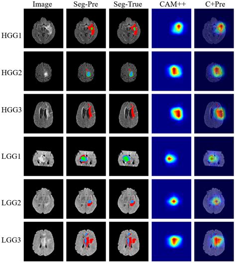 An Explainable Brain Tumor Detection Framework For Mri Analysis