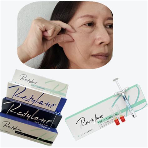 Cross Linked Dermal Filler Ha Fillers For Glabellar Lines Injection
