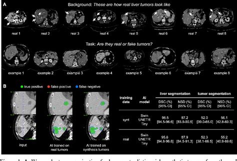 Synthetic Tumors Make Ai Segment Tumors Better Paper And Code Catalyzex