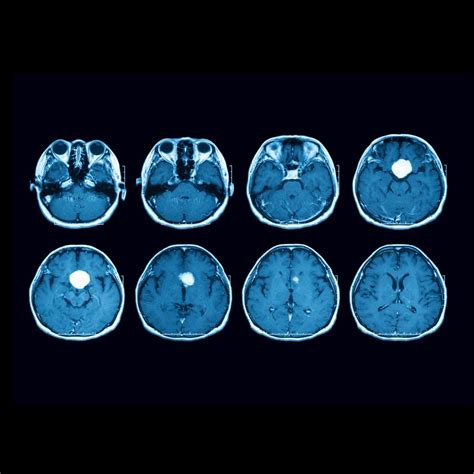 Microvascular Decompression For Trigeminal Neuralgia Nspc Brain And Spine Surgery