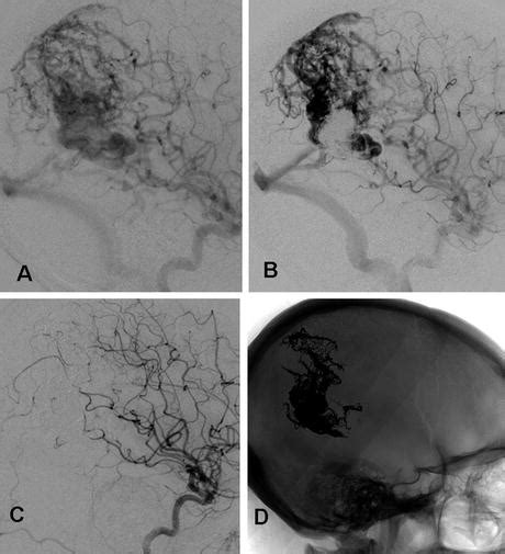 Intracranial Arteriovenous Malformations Radiology Key