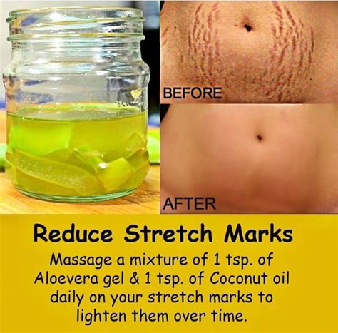 Pock Marks Remedy Stretch Mark Remedies How To Get Rid Natural