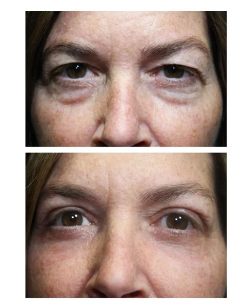 Lower Lid Blepharoplasty Aesthetic Eye Care