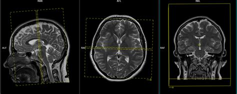 Normal Brain Mri With Contrast