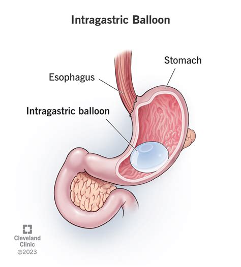 How To Make A Stomach Model