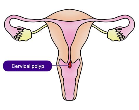 วิธีรักษาติ่งเนื้อที่ปากมดลูก มีวิธีไหนบ้าง ข้อดีและข้อจำกัด