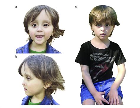 Clinical Photographs Of Our Patient At 3 Years Of Age A B Broad And