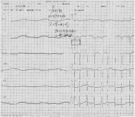 ECG Shows AF And ST Segment Depression And T Wave Inversion On Leads V5 V6 Download Scientific