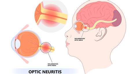 Optic Neuritis Symptoms And Treatment Moorfields Eye Hospitals