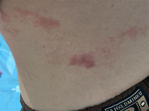 顏巧玲 回顧今年3🈷️初 我生病了😷 32～33是週末，我記得我睡醒後突然背部好痛，我以為我睡不好扭到筋骨，於是我貼了酸痛藥
