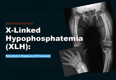 X Linked Hypophosphatemia Symptoms Diagnosis And Treatment