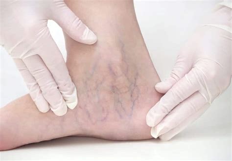 What Is Foam Sclerotherapy And What It Involves Practicalcme Medical