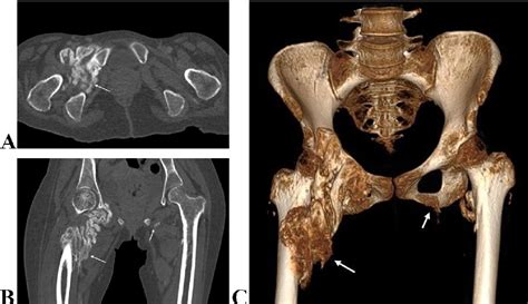 Figure 1 From Neurogenic Myositis Ossificans Of The Hip In A Patient