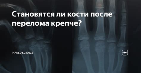 Становятся ли кости после перелома крепче Naked Science Дзен