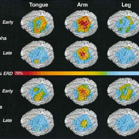Maps Of Ecog Spectral Analysis And Cortical Stimulation Results In