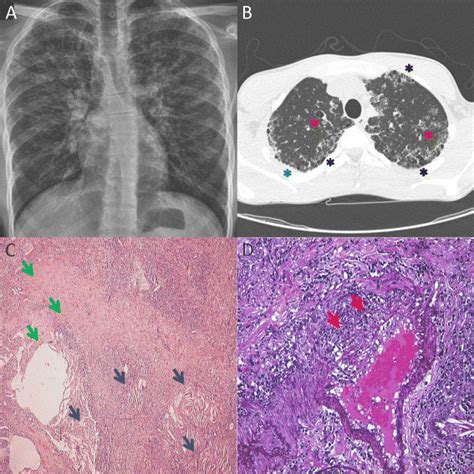 Pulmonary Changes In The Index Patient A Diffuse Bilateral Linear And Download Scientific