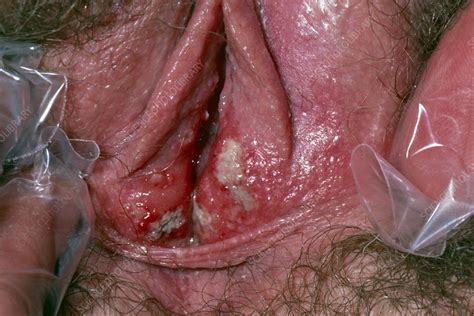 Vulval Ulcers Unknown Cause Stock Image M850 0190 Science Photo Library