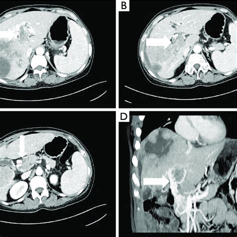 Portal Vein Carcinoma Thrombus With An Accessory Portal Vein Opening