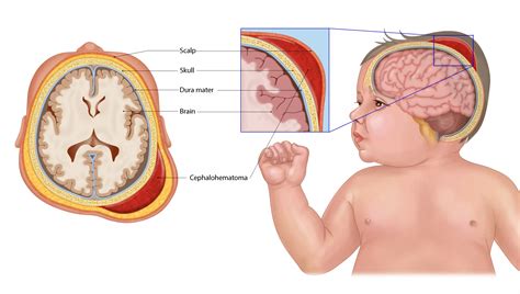 Scalp Hematoma