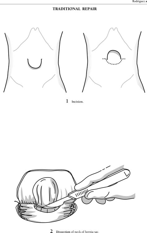 Figure 1 Surgical Management Of Umbilical Hernia