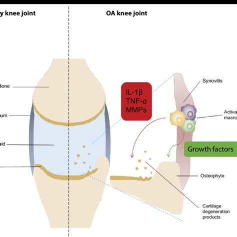 Kellgren Lawrence Grading System For Osteoarthritis Download Table