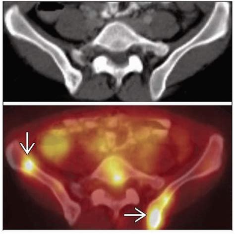 Non Hodgkin Lymphoma Radiology Key