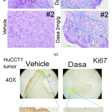 Glycolysis Inhibitor 3 Bromopyruvate Suppressed Hucct1 Progression