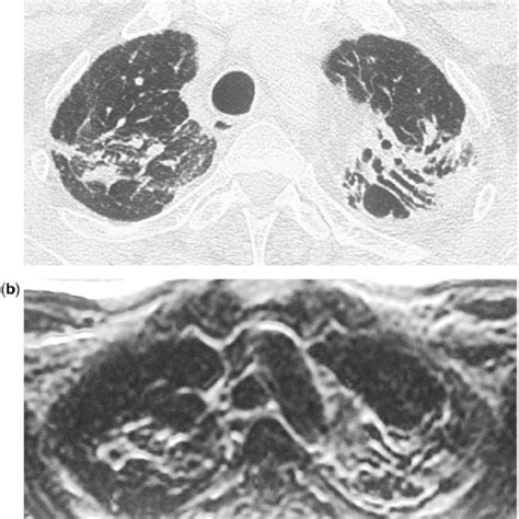 A 56 Year Old Man With Moderate Diffuse Chronic Fibrotic Pulmonary