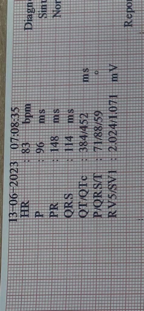 What Is The Meaning Of Qt And Qtc Recg
