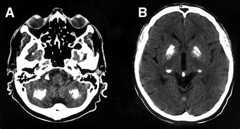 Calcification In Brain