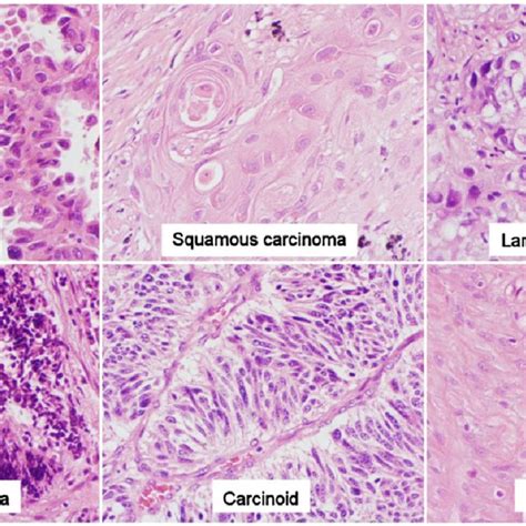Histological Profile Of Carcinomas Of The Lung And Pleura Stain