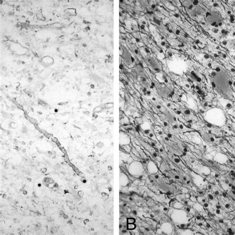 Mr Imaging Characteristics Of Tumefactive Demyelinating Lesions And