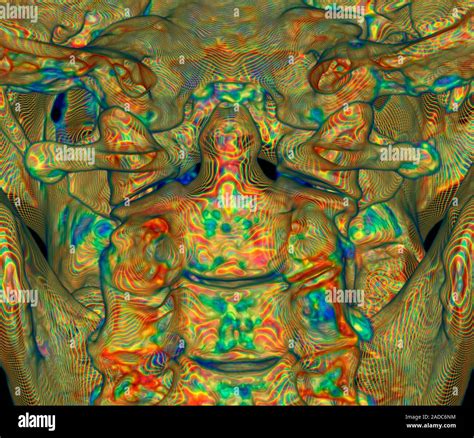 Upper Cervical Spine Digitally Enhanced 3d Computed Tomography Ct