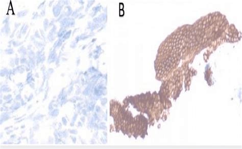 Histopathology From Tissue Sample Obtained At Time Of Ptc Download Scientific Diagram
