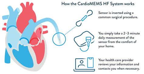 Team Hf Clinical Trial Patient Abbott
