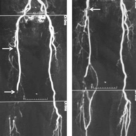 Pdf Late Lower Extremity Ischemia Due To Thrombi In An Occluded Graft